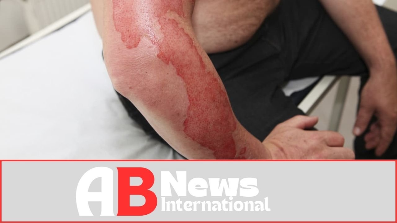 Melbourne man sues employer after suffering severe burns in workplace ...